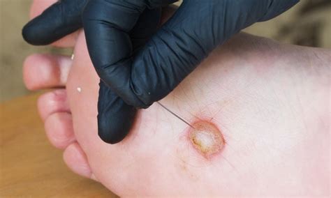 Diabetes And Foot Ulcers