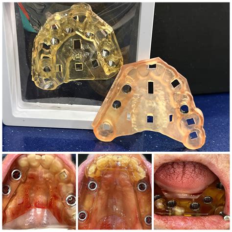 Cirugía Guiada en Implantología Clínica dm dental