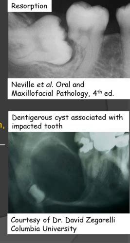 Abnormalities Of Teeth Ii Flashcards Quizlet