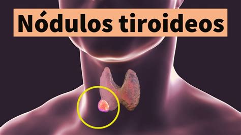 Lo Que Necesit S Saber Sobre Los N Dulos Tiroideos