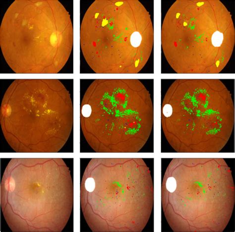 Segmentation Results Of Few Retinal Images From IDRiD Dataset A Input