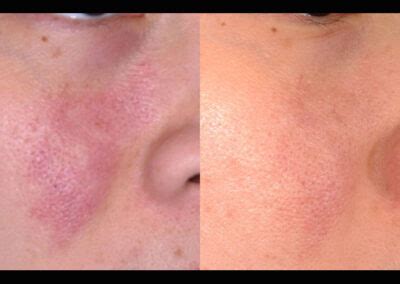 Vascular Birthmarks And Port Wine Stains Gateway Aesthetic Institute