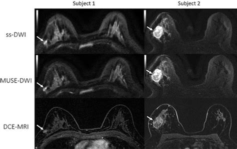 new dwi mri protocol looks promising for breast imaging scan for life