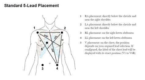 Lead Ecg Placement Diagram