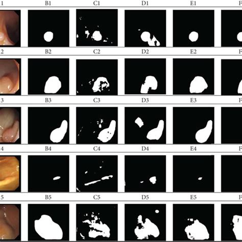 segmentation in colorectal endoscopy images ai original images bi download scientific