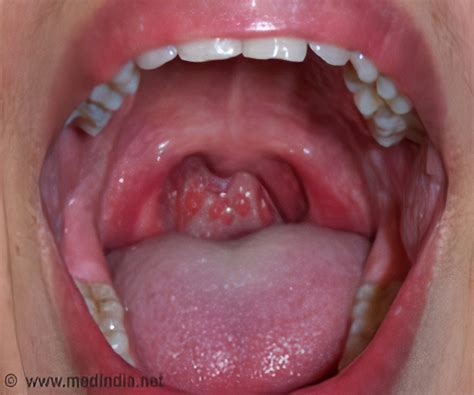 Sore Throat Telegraph
