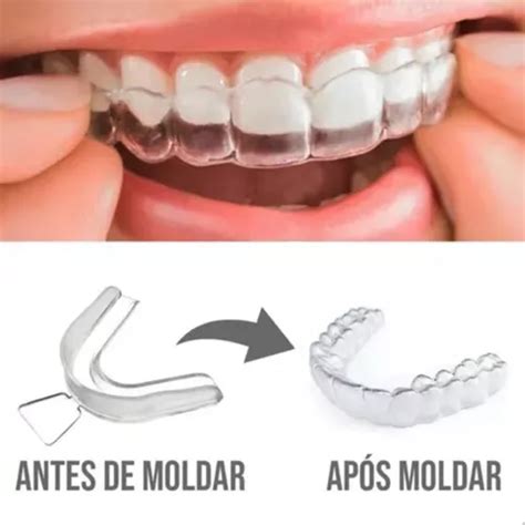 Placa De Silicone Moldável Para Bruxismo Ranger Dos Dentes MercadoLivre