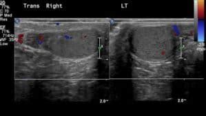 Testicular Torsion Uams Department Of Radiology