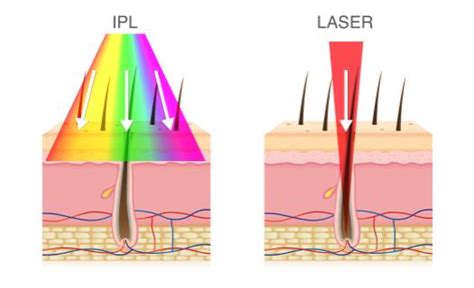 Appareil dépilation définitive au Diode Laser Professionnel Epil Pro II