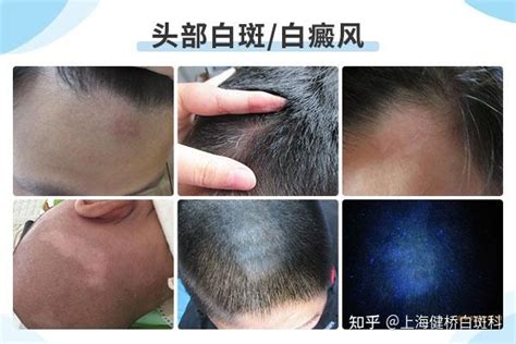 上海白癜风医院治疗哪个好 额头白癜风有哪些症状表现 知乎
