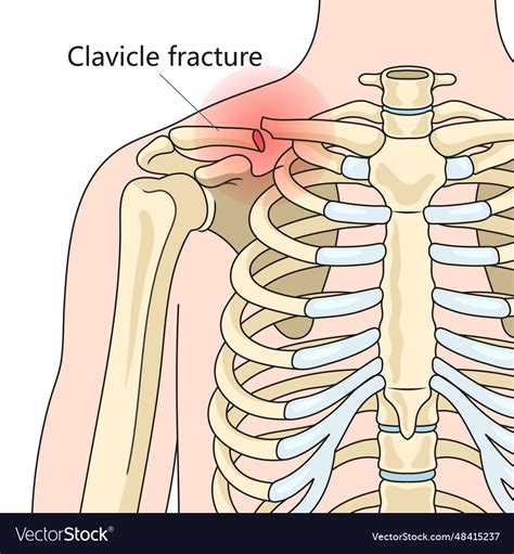 Clavicle Fracture Broken Collarbone Symptoms Diagnosis Treatment