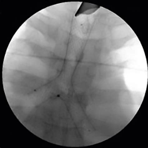 Carina Y Stent Micro Tech Europe