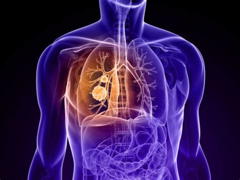 Tumore Ai Polmoni E Stadio Malattia Medicinalive