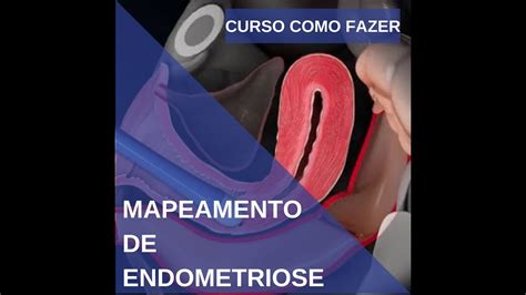 Curso De Ultrassonografia Para Pesquisa De Endometriose Aula