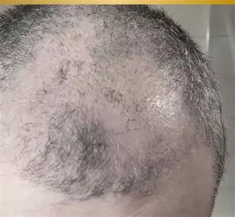 Nos résultats de greffe de cheveux mois par mois chez Klineva