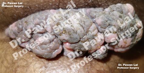 Anal Warts And Swelling Telegraph