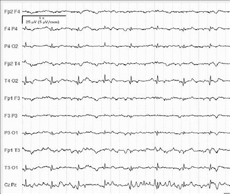 the electrocardiogram ecg artifact is visualized on all electrodes download scientific