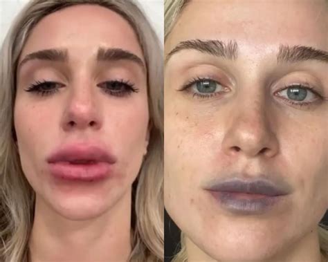 Tiktoker faz preenchimento labial e resultado é desastroso Veja fotos