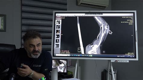 Kol Veya Bacakta Damar Yuma Prof Dr Ahmet Akg L Youtube