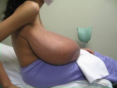 See And Save As Macromastia Monster Tits Porn Pict 4crot