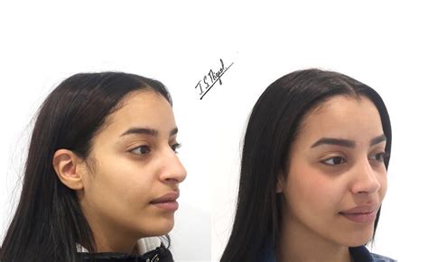 Rinoplastia Casos Antes Y Despu S Dr Joan San Miguel