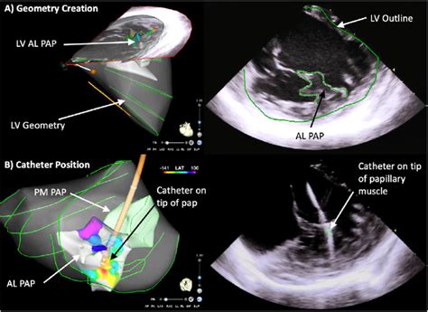 Intracardiac Echocardiography To Guide Papillary Muscle Vt Ablation
