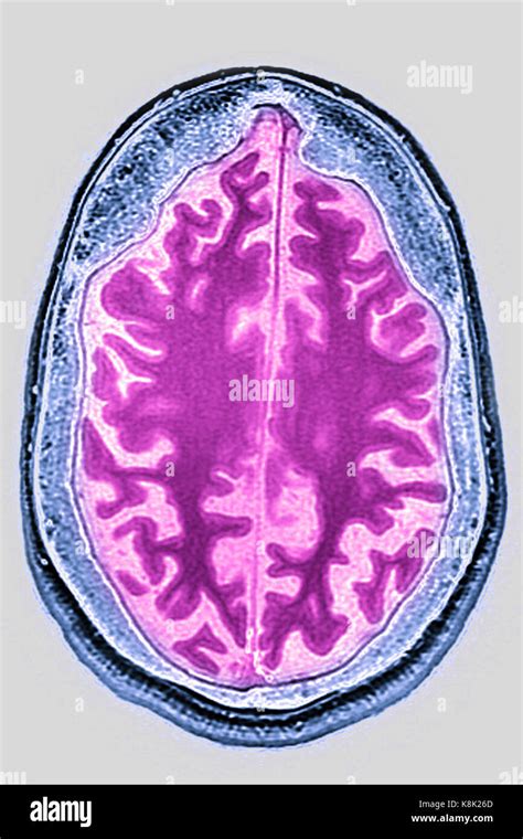 CEREBRAL ATROPHY MRI Stock Photo Alamy