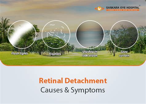 Retinal Detachment Symptoms Sankara Eye Foundation