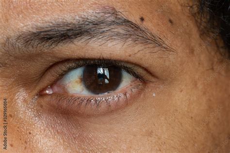 What Causes Brown Spots On Sclera Infoupdate Org