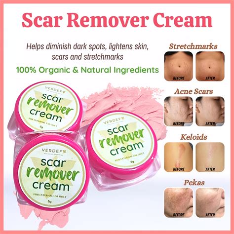 Keloid Stretch Mark Remover Cream Scar Remover Cream MIRACLE CREAM
