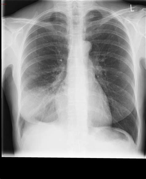 Pleural Effusion Chest X Ray Sophie Miller
