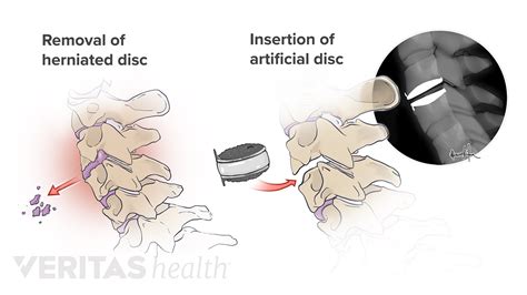 How To Repair A Bulging Disk Memberfeeling16