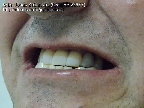 Reabilitação Estética Facetas Diretas em Resina Composta Caso