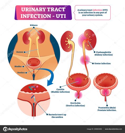 Urinary Tract Infection Or UTI Vector Illustration Labeled Medical