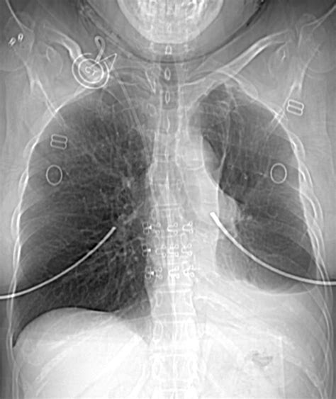 187Lu Loculated Pleural Effusion Lungs