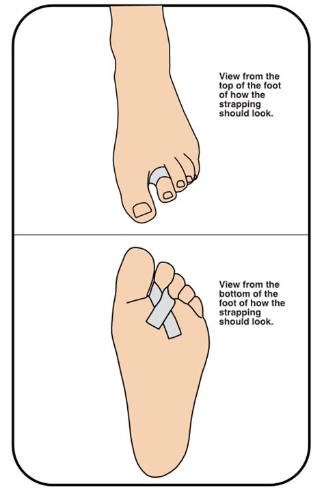 Management Of Toe Deformities Chelsea And Westminster Hospital NHS