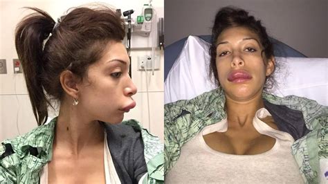 12 cirurgias plásticas dos famosos que deram muito errado antes e depois