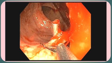Clip Hemostasis II Hemo Clip Application II BD ENDOSCOPY YouTube