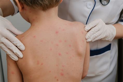 Chicken Pox Cases 2024 Aurel Caresse