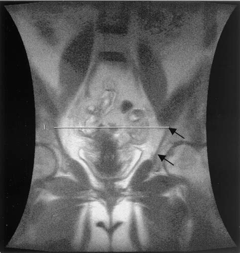 Figure 1 From Architectural Differences In The Bony Pelvis Of Women