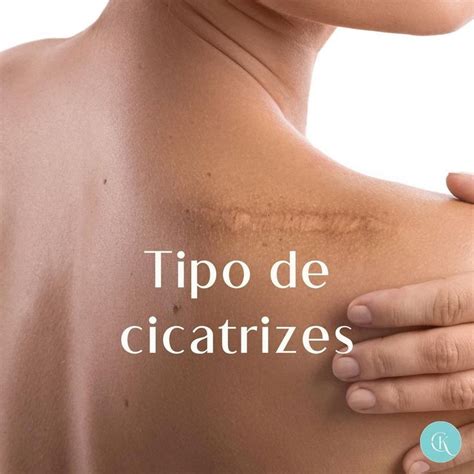 Tipos de cicatriz Cicatrizes Quelóide Acne