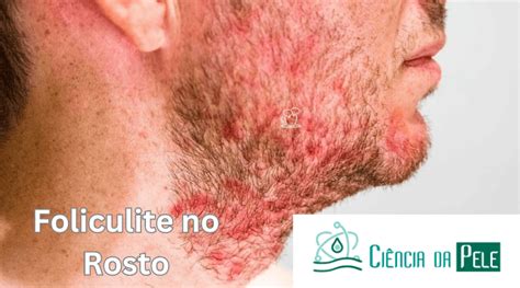 O que é foliculite Causas sintomas e tratamentos Ciência da Pele