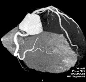 Coronary Computerised Tomographic Angiogram Coronary Cta Peter Yan