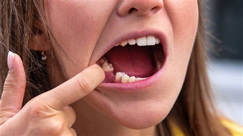 Qué es la agenesia dental y cómo afecta a la salud oral Carlos Saiz