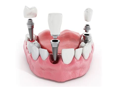 Problemas comunes en la colocación de implantes dentales Maxilodexeus