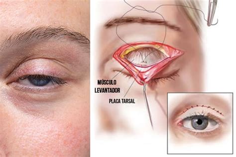 Ptose Palpebral Dr Renato Fusaro