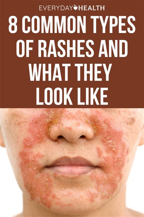 8 Common Types Of Rashes And What They Look Like Types Of Rashes Types Of Skin Rashes Common