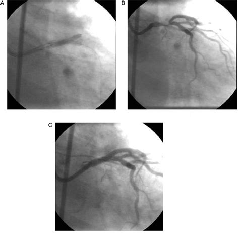 Stenting Of Left Main Coronary Artery Stenosis A To Z Heart Asia