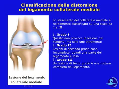 Lesione Del Collaterale Mediale Del Ginocchio I Sintomi E Cosa Fare