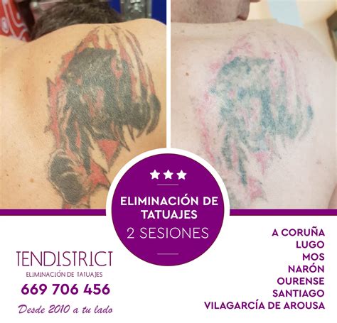 Láser para quitar tatuajes en A Coruña Tendistrict